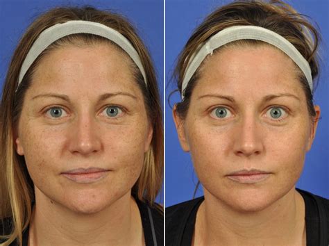 Clear Brilliant Before And Afters Austin Laser Solutions