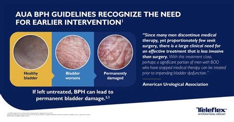 Trey Dorman On Linkedin The Aua Bph Guidelines Recognize The Need For
