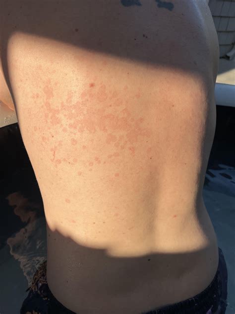 Rash That Ignited Whenever Im Hot R Diagnoseme