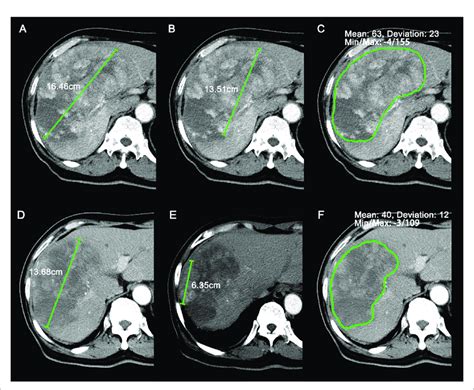 Representative Case 69 Year Old Male Patient Of Target Lesions Download Scientific Diagram