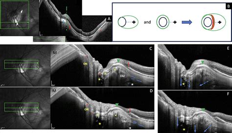 Understanding Posterior Staphyloma In Pathologic Myopia Opth