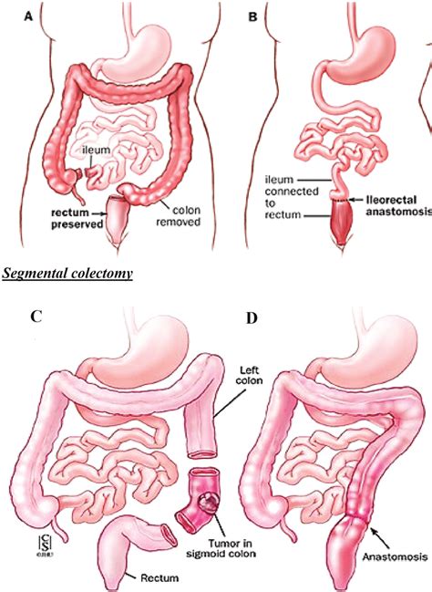 Total Abdominal Colectomy