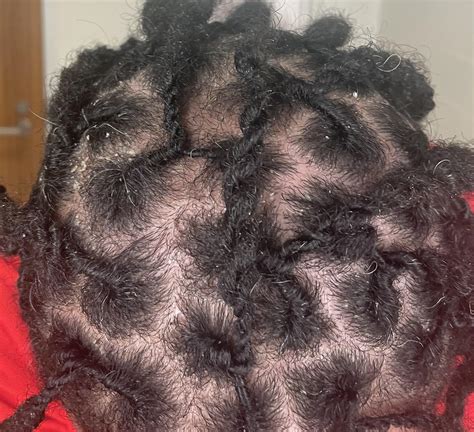 Seborrheic Dermatitis Questions R Locs