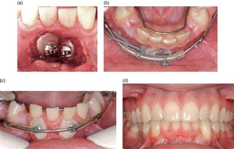 Eruption Problems Pocket Dentistry