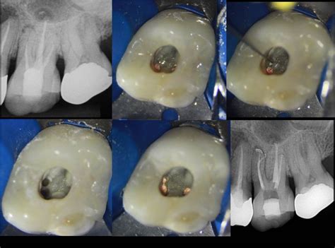 Locating The Second Mesiobuccal Canal In Maxillary Molars Challenges Ccide