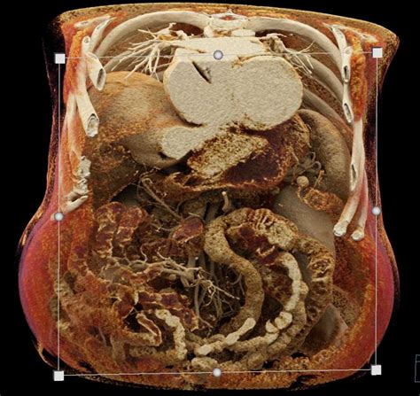 Gastric Gist Tumor Stomach Radiology Case Studies Ctisus Ct Scanning