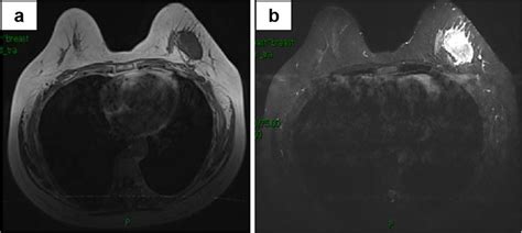 Mri Revealed A Mass Measuring 42 × 29 × 28 Mm In The Upper Outer