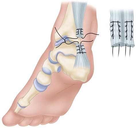Open Repair Of Achilles Tendon Rupture Clinical Tree