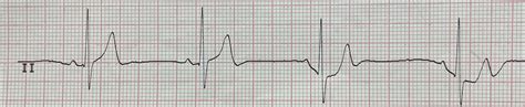 Solved Please Calculate The Heart Rate From The ECG Data Chegg