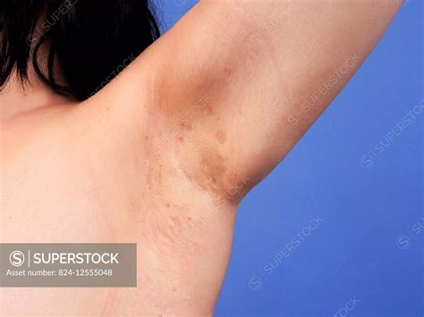 Hidradenitis Suppurativa In The Armpit Superstock