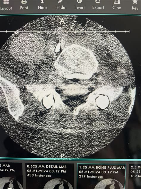 Screws Piercing Vertebral Cortex Dx From Cat Scan Of 4 Yo Lumbar Alif