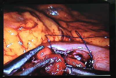 Gastrointestinal Stromal Tumor GIST The Gastrointestinalatlas Gastrointestinalatlas Com