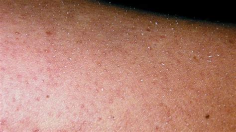 Keratosis Pilaris Diet: Why It Doesn't Work, Plus Proven Remedies