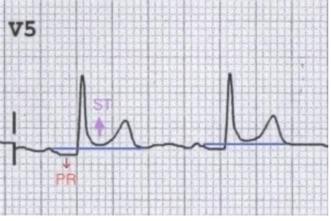 Ecg Pathologies Flashcards Quizlet