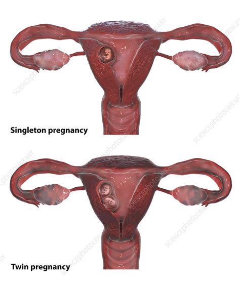 Singleton And Multiple Pregnancy Illustration Stock Image F0344564 Science Photo Library