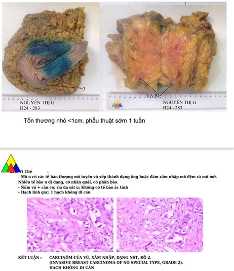 Vietnamese Medic Ultrasound Cases 742 743 2 Cases Of Breast Tumor