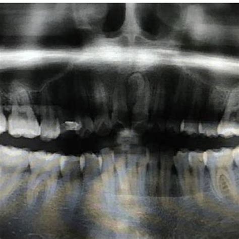 Pdf How Does Mandible Impacted Third Molar Become Vertical In Young Adult