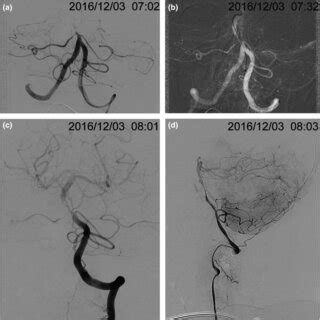 Image DSA Frontal Plane A Cerebral Angiography Before Procedure Download Scientific Diagram