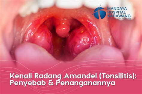 Kenali Radang Amandel Tonsilitis Penyebab Gejala And Penanganannya