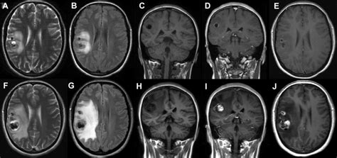 Calcifying Pseudoneoplasm Of The Neuraxis A Case Illustrating Natural