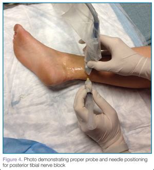 Emergency Ultrasound Ultrasound Guided Posterior Tibial Nerve Block MDedge