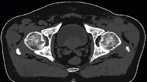 A Constructed Mri Based Pseudo Ct Image Of A Prostate Cancer Patient Download Scientific Diagram