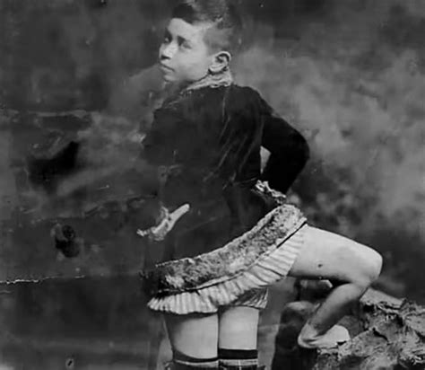 The Extraordinary Life Of The Three Legged Man