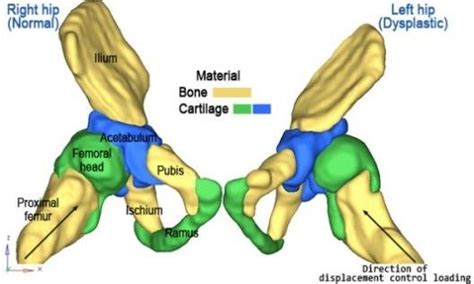 Computational Infant Hip Model Download Scientific Diagram