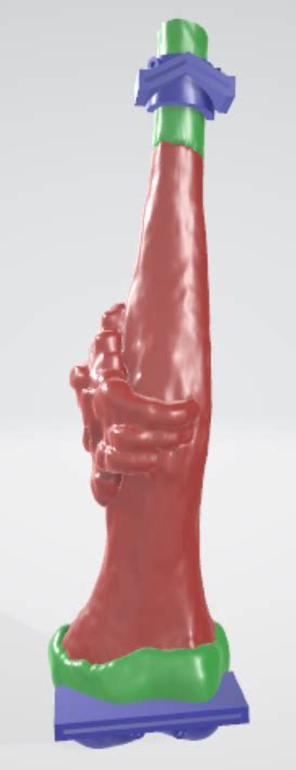 Obj File Femoral Sarcoma And Surgical Guide ♋ ・3d Printer Model To