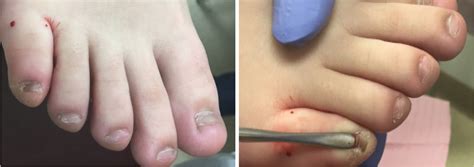 Current Concepts In Nail Surgery