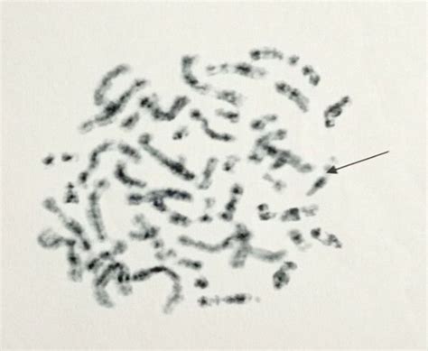 Rapidly Progressing Plasma Cell Leukemia With Underlying Plasmablastic
