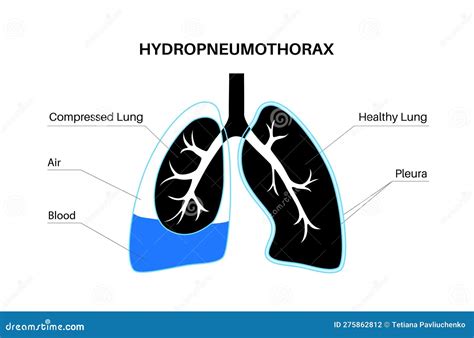 Hydropneumothorax Medical Poster Stock Vector Illustration Of