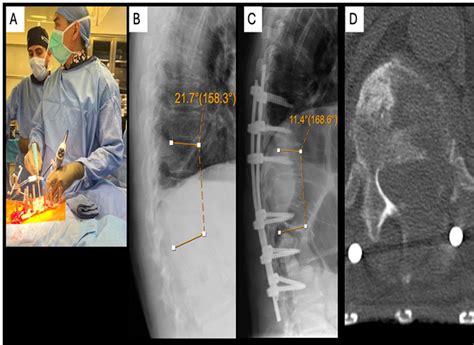 Circumferential Decompression Of Thoracic Spinal Cord Via Endoscopic Biportal Transpedicular