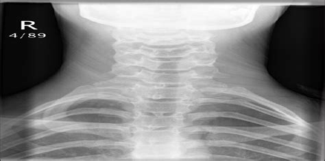 Bilateral Thoracic Outlet Syndrome An Uncommon Presentation