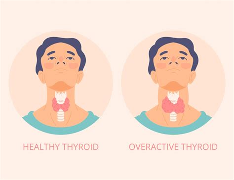 Thyroid Nodules Treatment In Jaipur Dr Amol Nagvekar