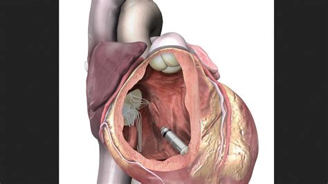 Fda Approves Medtronics Next Generation Micra Pacemakers