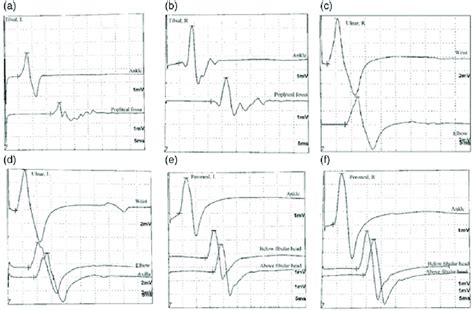 Motor Nerve Conduction Study A Left Tibial B Right Tibial C Download Scientific