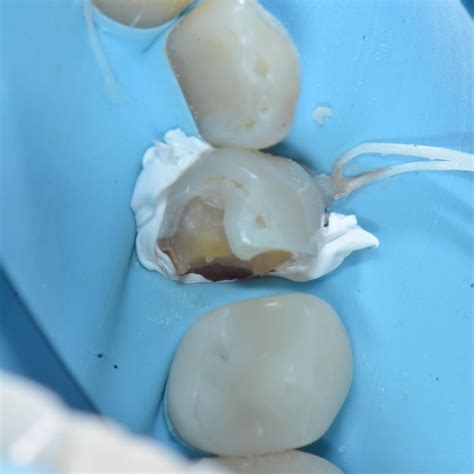 Deep Margin Elevation And Biologic Width — Alleman Center Of Biomimetic Dentistry