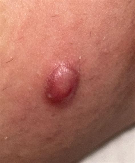 Cyst Near Bikini Line