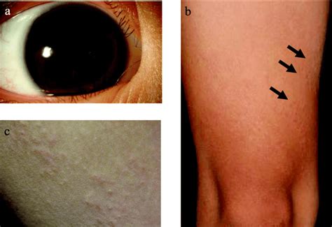 Clinical Findings A Anterior Chamber Inflammation In Both Eyes And