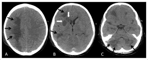 Noncontrast Head Computed Tomography Ct Images A Extensive White Download Scientific