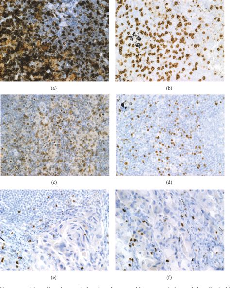 Table 1 From Elevated Foxp3 Cd8 Ratio In Lung Adenocarcinoma Metastatic