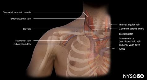 Tips For Subclavian Vein Cannulation Nysora