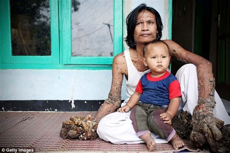 Indonesian Known As The Tree Man Due To Disease Dies Daily Mail Online