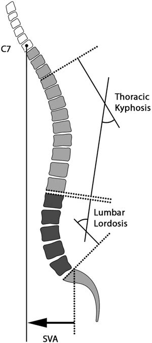 Pdf Sagittal Spinal Pelvic Alignment Semantic Scholar