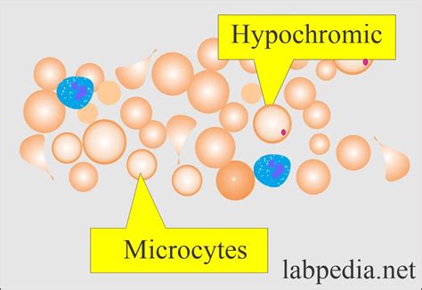 Red Blood Cell Rbc Part 5 Summary Of Rbc Morphology