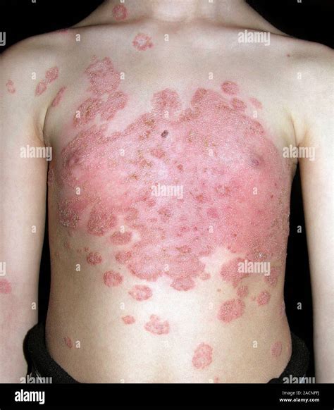 Red Patches On The Skin Of The Chest And Abdomen In A Young Female