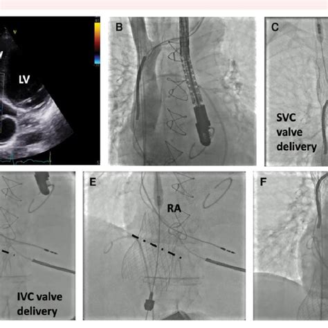Transthoracic Echocardiogram Of Patient 2 Apical Four Chamber View Download Scientific