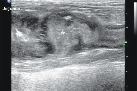 Ultrasonography Of The Gastrointestinal Tract Stomach Duodenum And