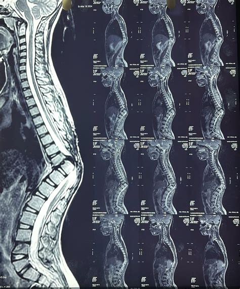 Dr Shiv Narayan Pandey On Linkedin Pott Disease Also Known As Tuberculous Spondylitis Is A